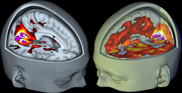 Cientistas estudam 'dissolução do ego' e outros efeitos do uso de LSD ...
