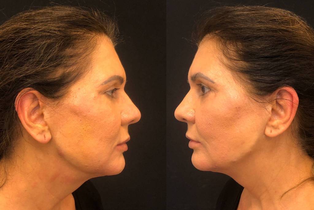 Fios de PDO ajudam a eliminar rugas e custam até R$ 6 mil - 31/08/2022 - Equilíbrio - Folha